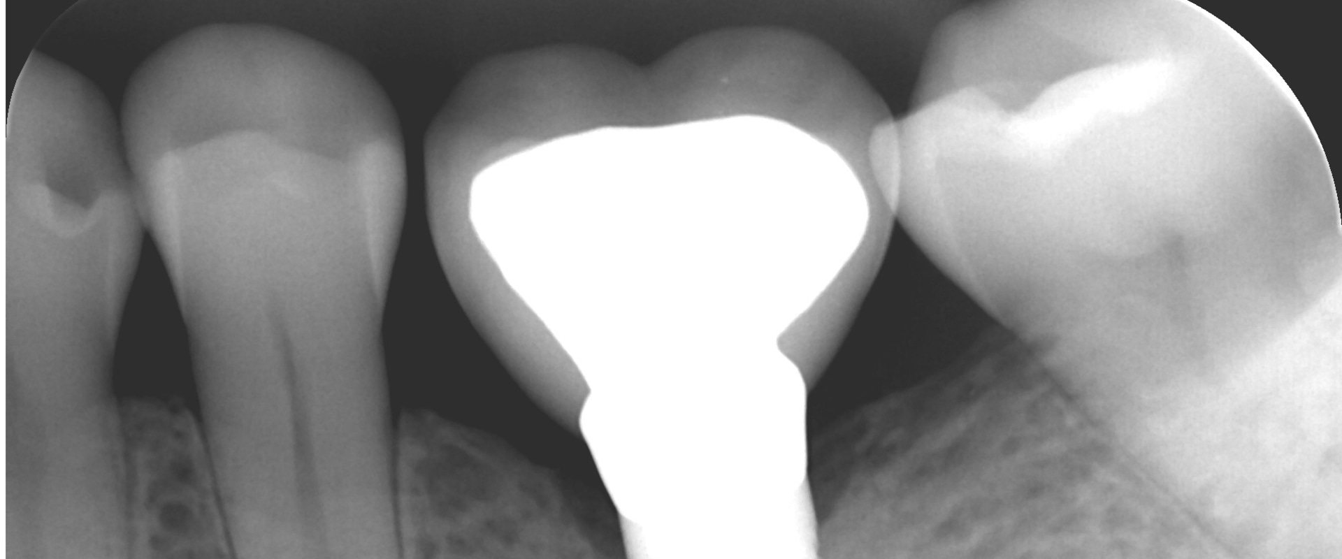 What is the Gap between Implant Crown and Tooth?