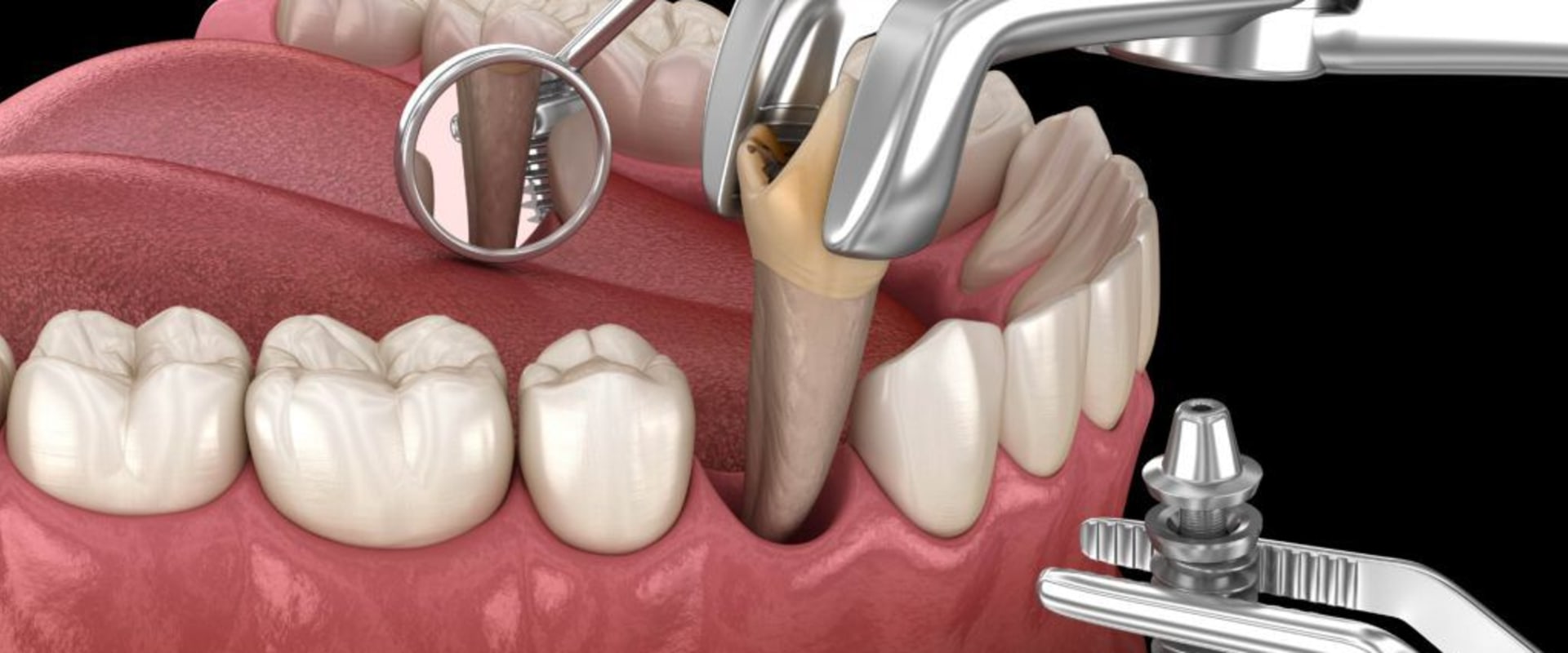 Should You Get an Implant After Tooth Extraction?